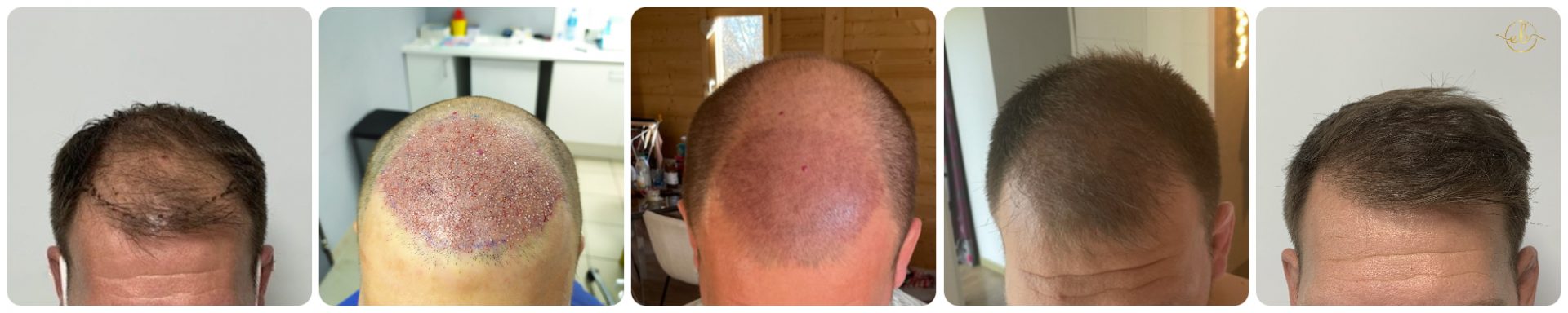 FUE Hair Transplant Timeline - Dr Bonaros - Glasgow FUE Hair Transplant Timeline - Dr Bonaros - Glasgow