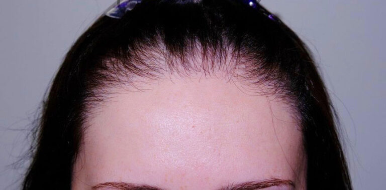 Transgender Hair Transplant - Hair Transplant Glasgow - Dr Bonaros