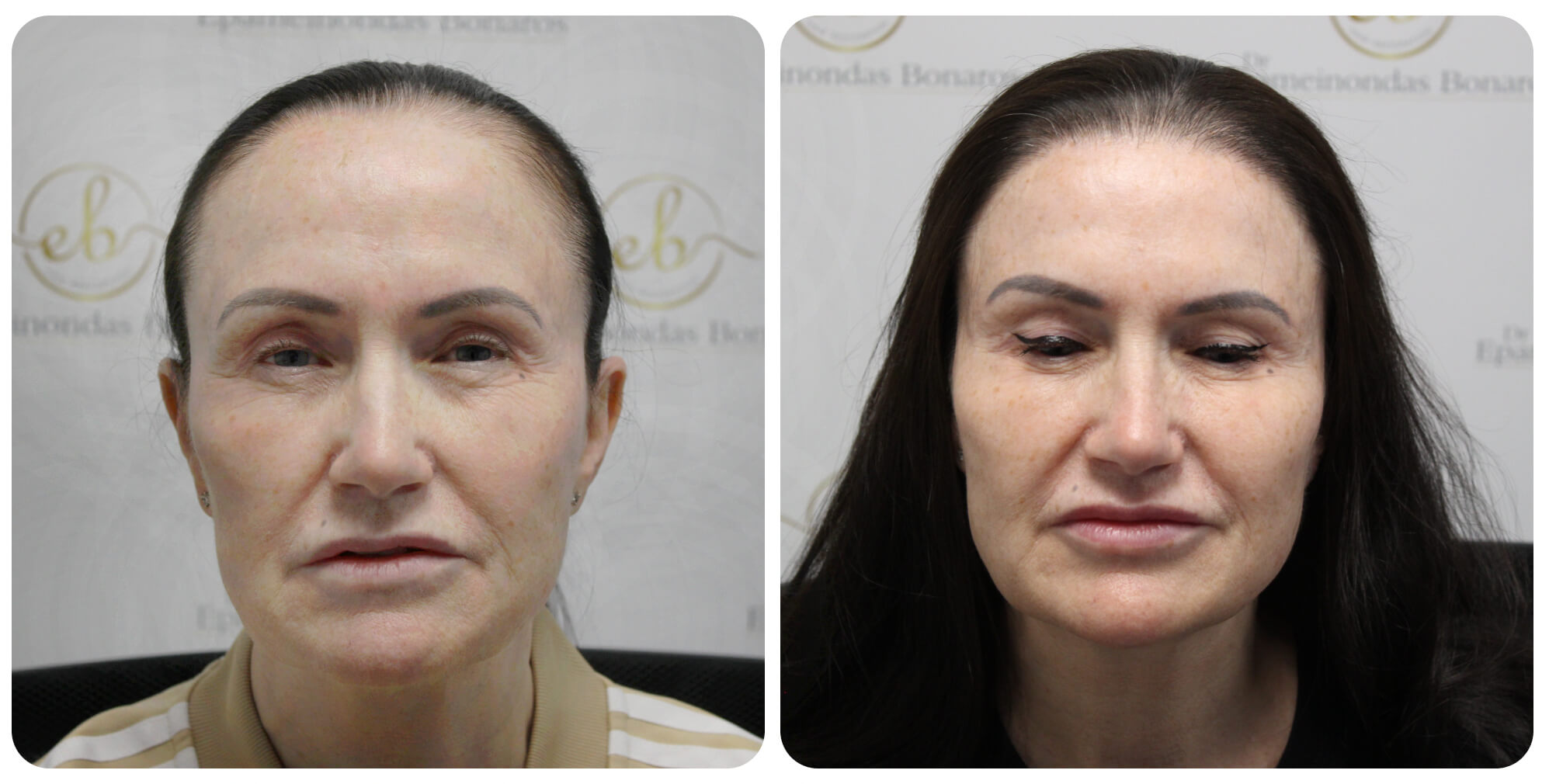 FUE Transplant Before & After - Case Study 10 | Dr Bonaros