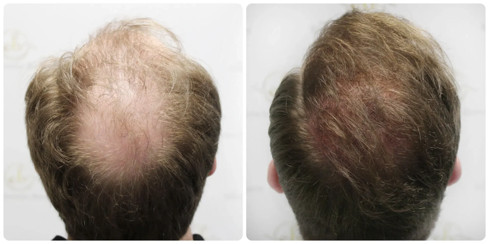 FUE Transplant Before & After - Case Study 2 | Dr Bonaros